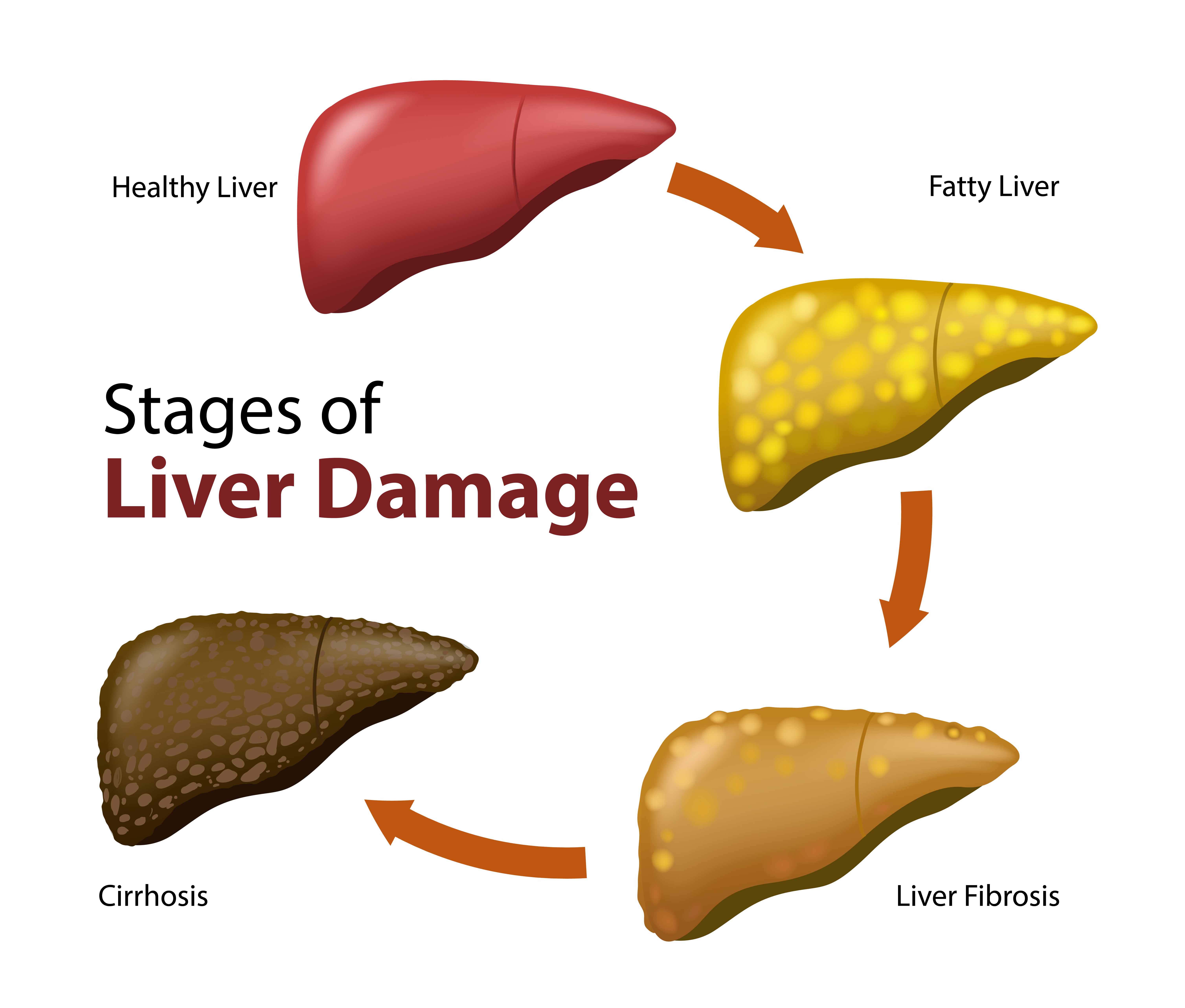 Final Stage Cirrhosis Of The Liver Symptoms Fatty Liver